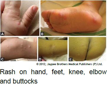 Hand, Foot and Mouth Disease (HFMD) – Ministry of Health & Wellness ...
